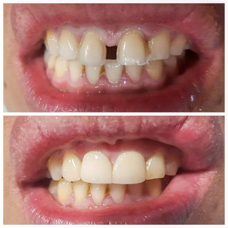 How to Fill Gap After Tooth Extraction